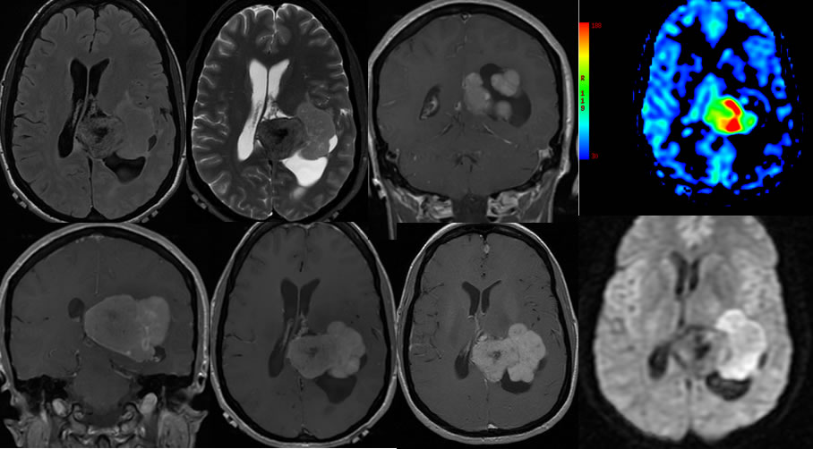Intraventricular meningioma