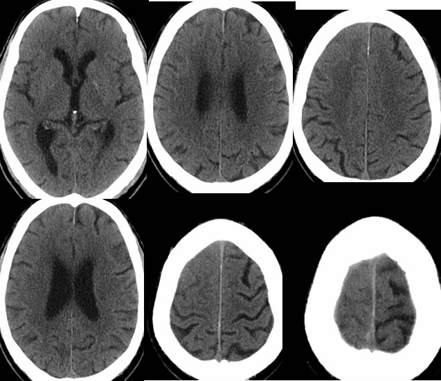 meningitis