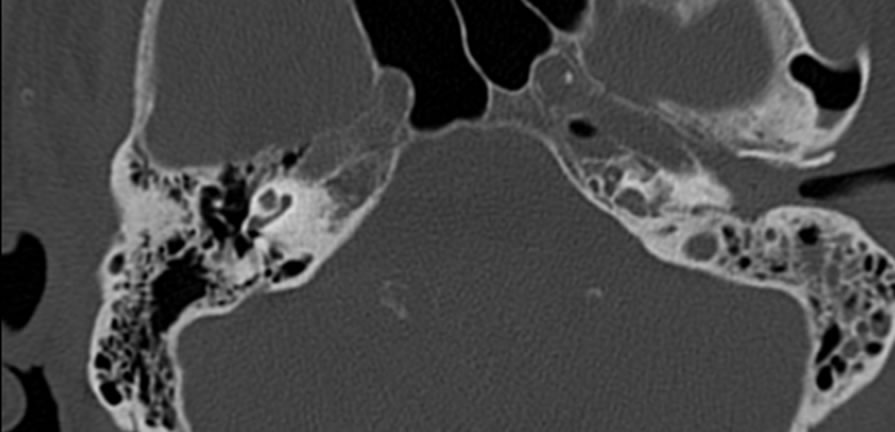 malignant otitis externa