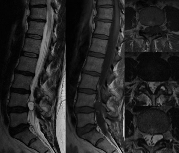 Synovial Cyst Lumbar Mri