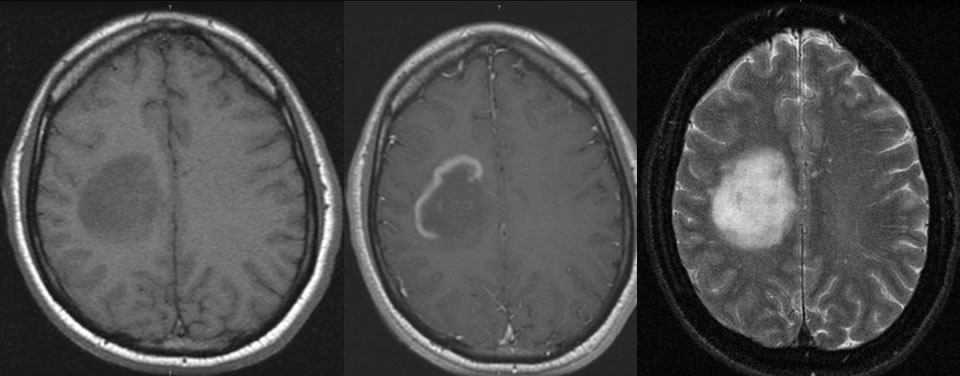 tumefactive demyelination